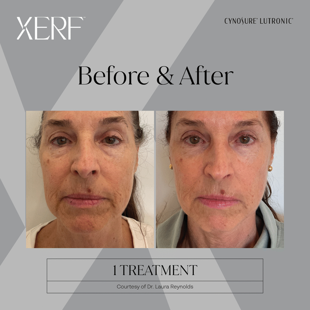 Xerf Treatment Results | Before & After – Eve Aesthetics