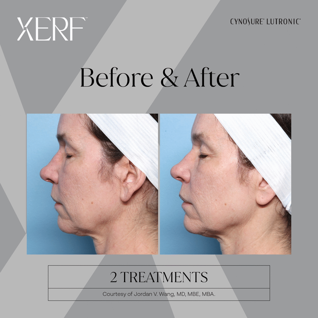 Xerf Treatment Results | Before & After – Eve Aesthetics