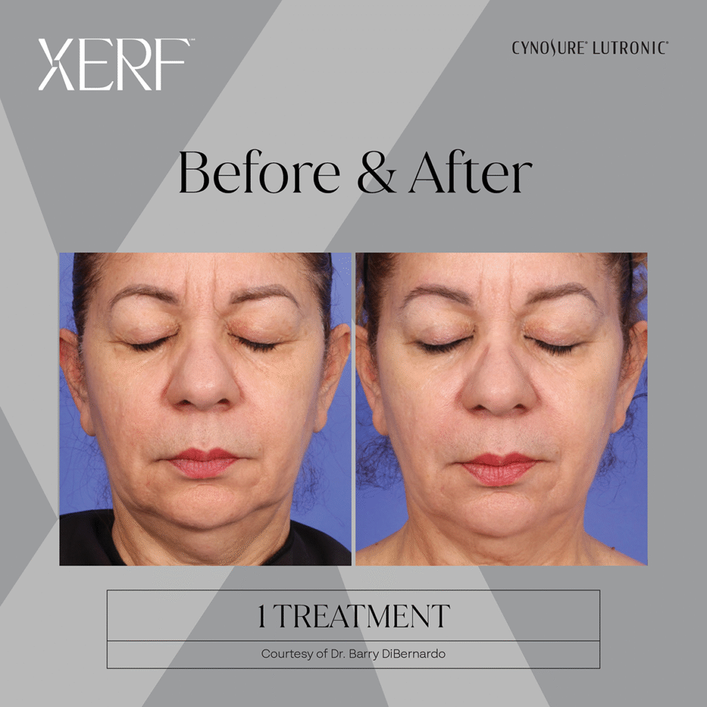 Xerf Treatment Results | Before & After – Eve Aesthetics