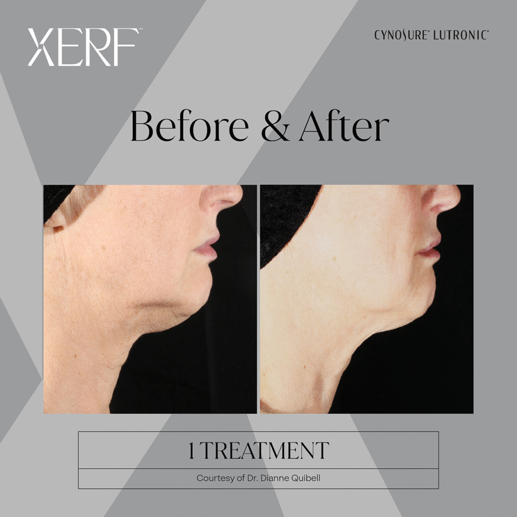 Xerf Treatment Results | Before & After – Eve Aesthetics