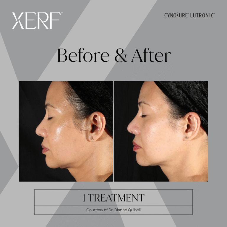 Xerf Treatment Results | Before & After – Eve Aesthetics