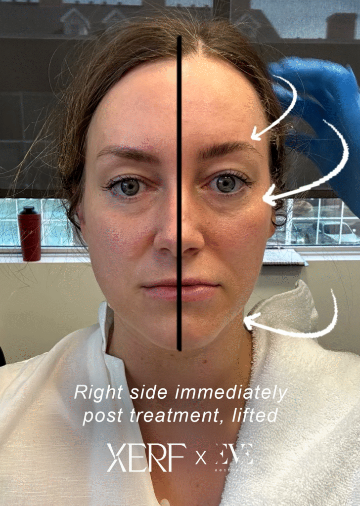 EVE Xerf Treatments | Advanced Non-Surgical Skin Tightening
